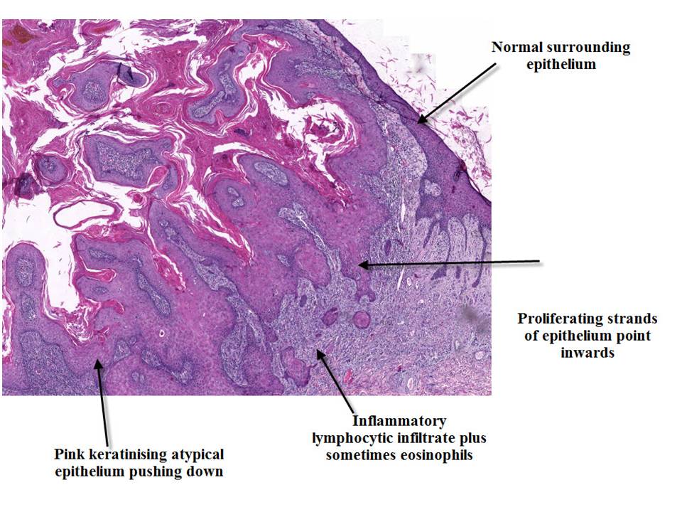 Dermpath Made Simple - Neoplastic: Squamous cell Carcinoma