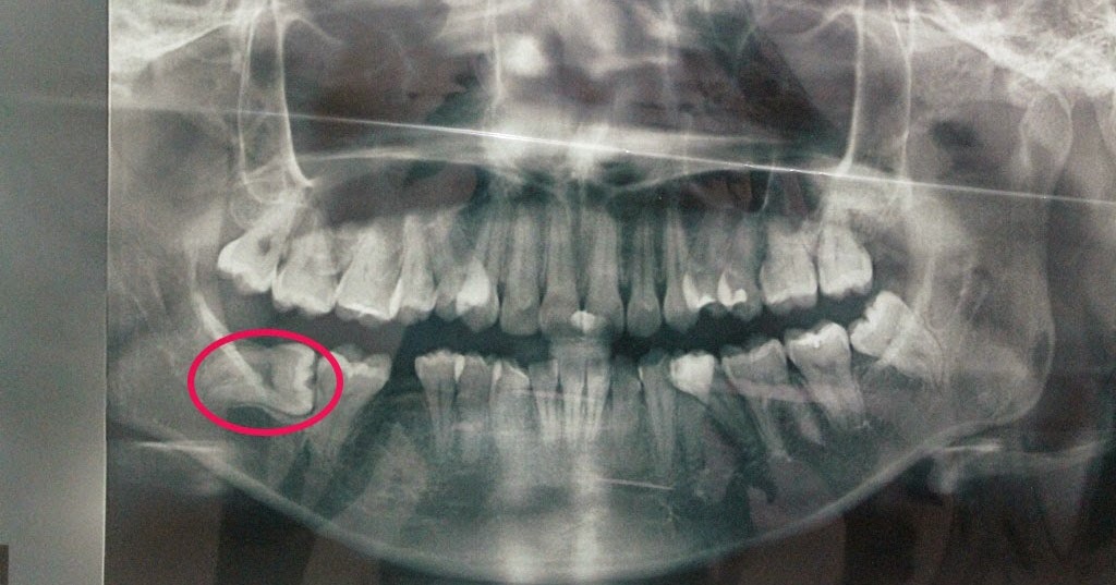 diary of hani: Pengalaman Pertama Odontektomi