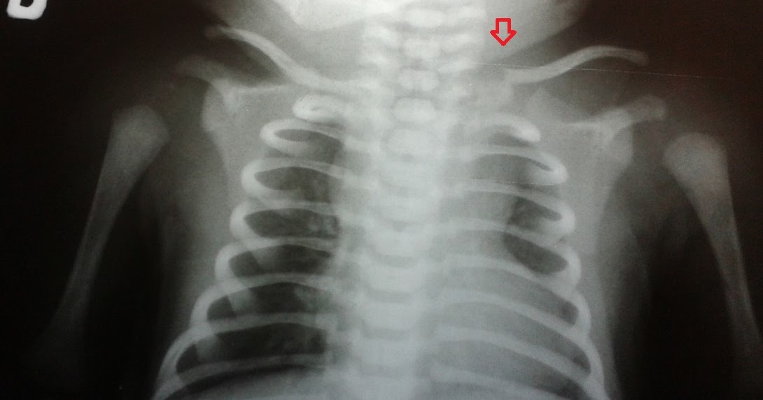 DICAS DE RADIOLOGIA - Tudo Sobre Radiologia: IMAGENS RADIOLÓGICAS - FRATURA DE CLAVÍCULA RECÉM ...