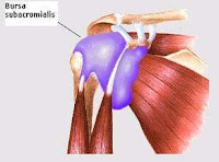 Bursitis Subdeltoidea