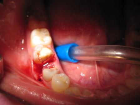 Schön Dental: Molar Hemisektion and restoration (by Drg. Henri Mudjono)