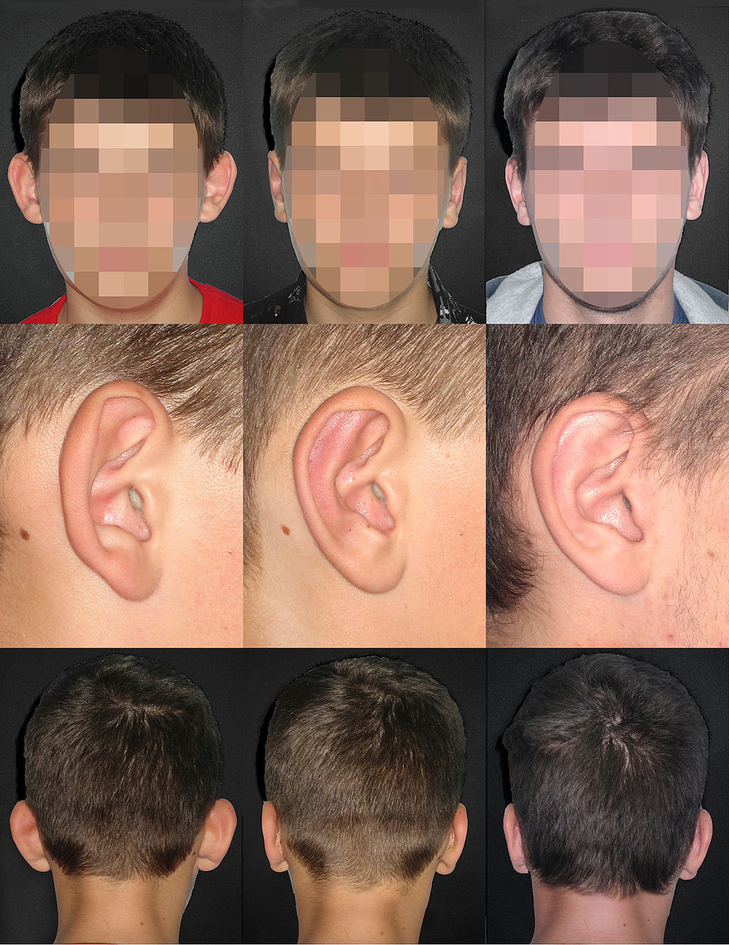 Cosmetic Surgery for children