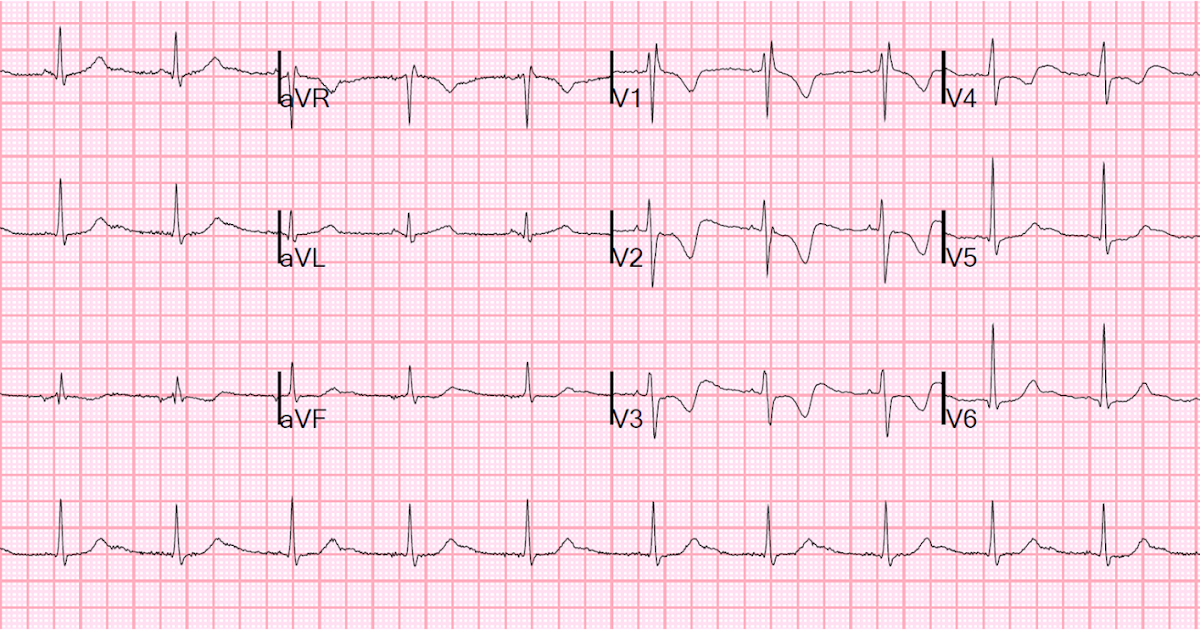 Dr. Smith's ECG Blog: A woman in her 20s with syncope