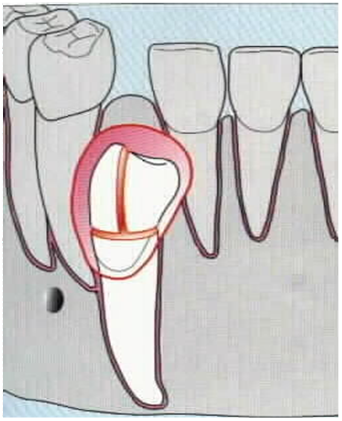 Dentistry and Medicine: Surgical management of Unerupted and Impacted teeth