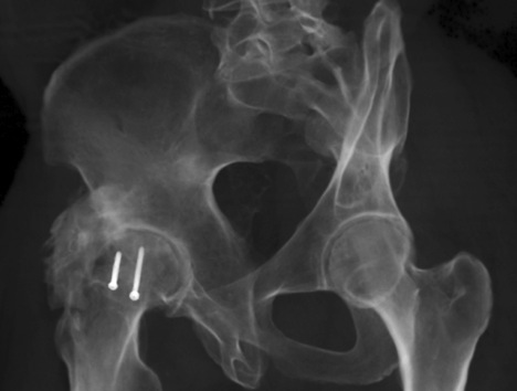 Case of the Month: Fracture cases at Harborview Medical Center ...