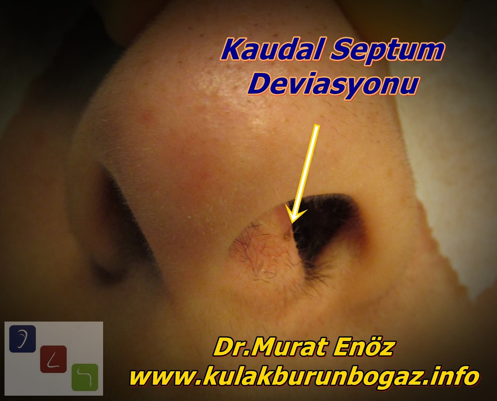 Hastam "Kaudal Septum Deviasyonu" nu Kağıda Çizerek Anlatmış!