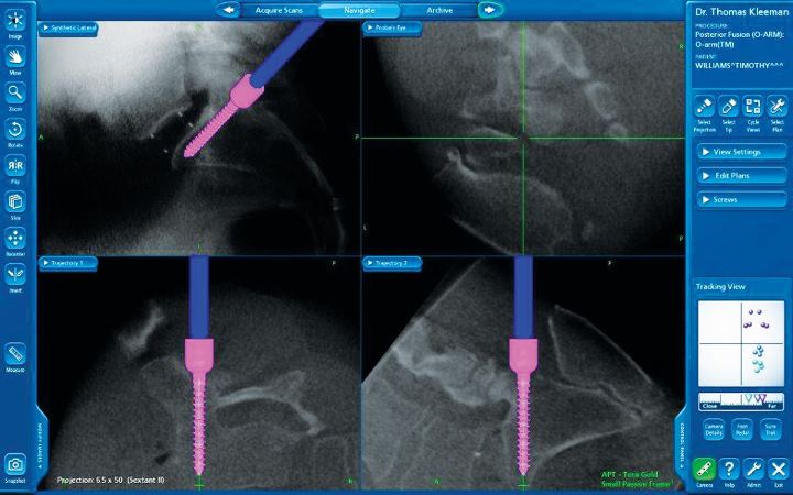 New Hampshire NeuroSpine Institute: OLIF - The Oblique Lumbar Interbody ...
