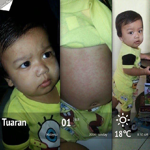 Roseola Infantum - Cik Azizah