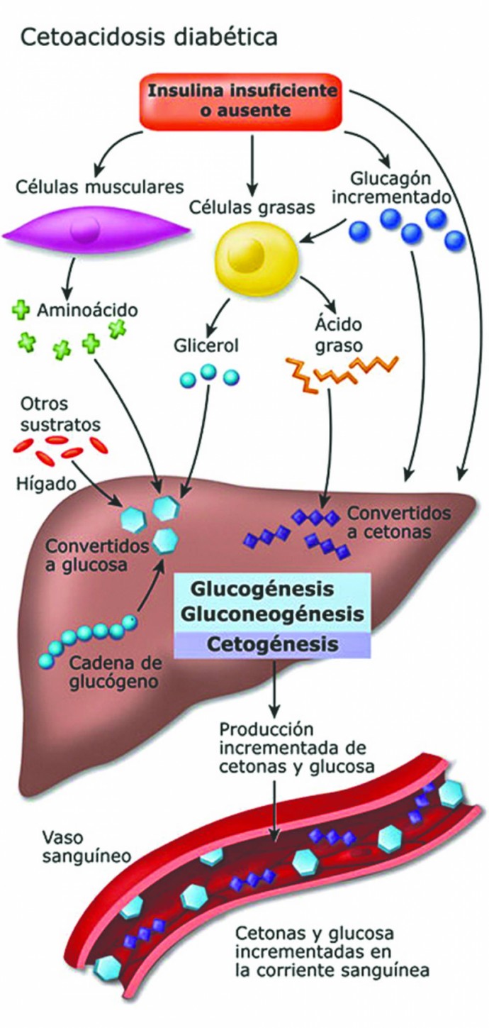Cetoacidosis Diabética | Diagnostico Medico