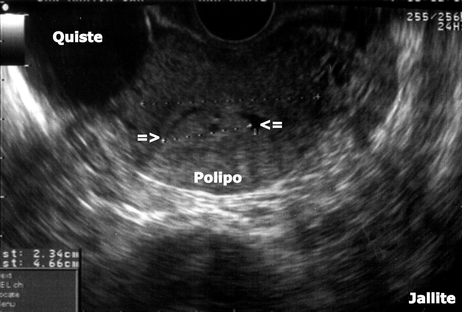 Polipo Endometrial & Quiste Ovarico Complejo