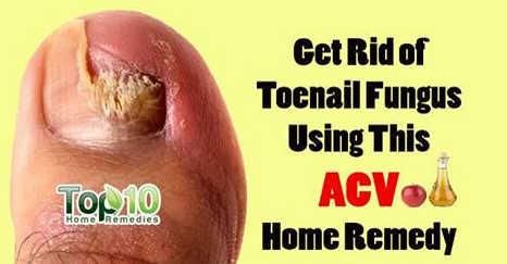 Easy Home Remedy to Get Rid of Toenail Fungus Naturally - Style Hunt World