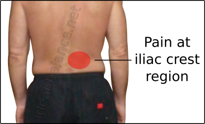 Ideal Balance Acupuncture: Iliac Crest Syndrome