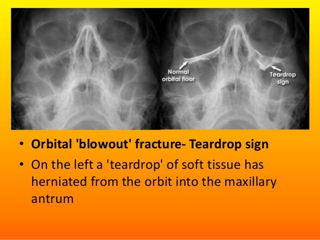 EXAMS AND ME : Vision 2020: Tear Drop Sign