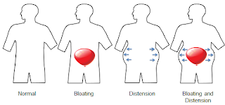 NUTRIENDO-JL: Gases y Distensión Abdominal