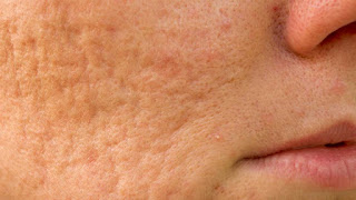 LATEST TREATMENT METHODS OF ACNE SCARS IN COSMETOLOGY