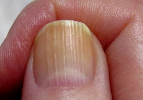 Aranyosfodorka napjai: Köröm, ami nem öröm