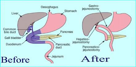 A blog about conditions related to the gastrointestinal tract, liver ...