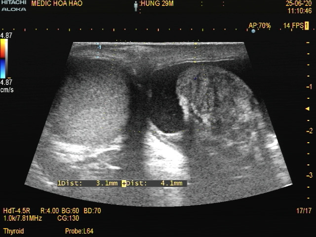 VIETNAMESE MEDIC ULTRASOUND: CASE 589: TB OF TESTIS, Dr PHAN THANH HẢI ...