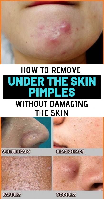 How To Remove Under The Skin Pimples Without Damaging Your Skin
