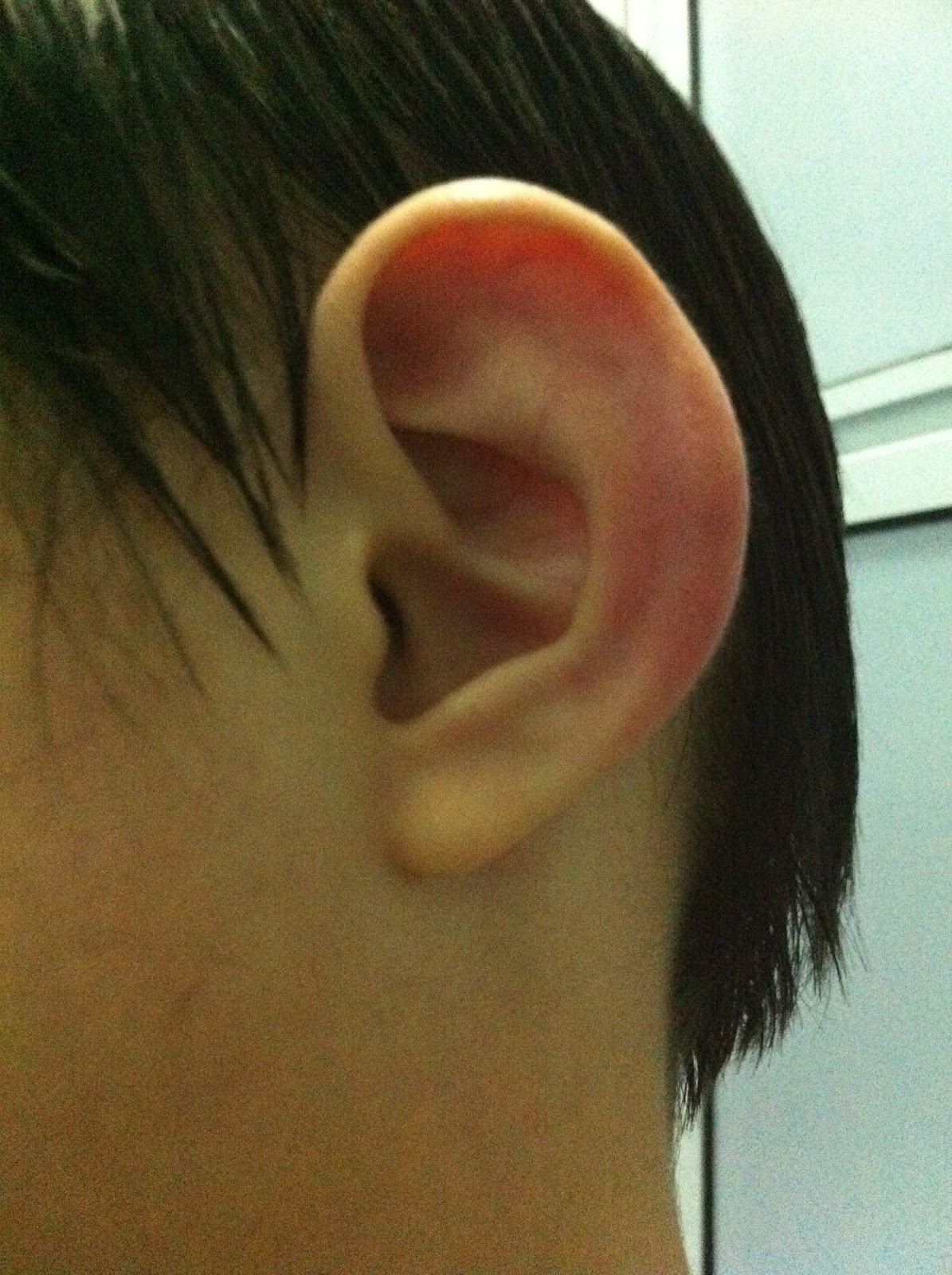 My Swollen Ear