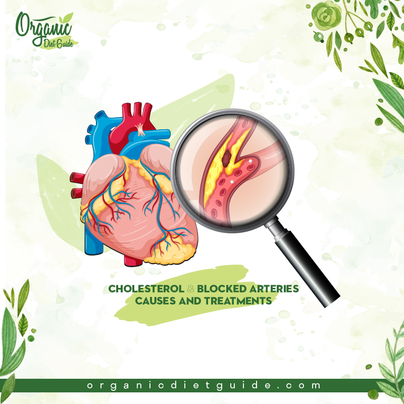 organicdietguide: Cholesterol & Blocked Arteries – Causes and Treatments