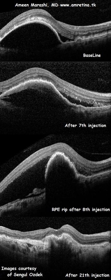 RPE tear Case report and Discussion