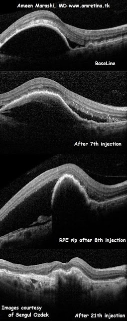 RPE tear Case report and Discussion