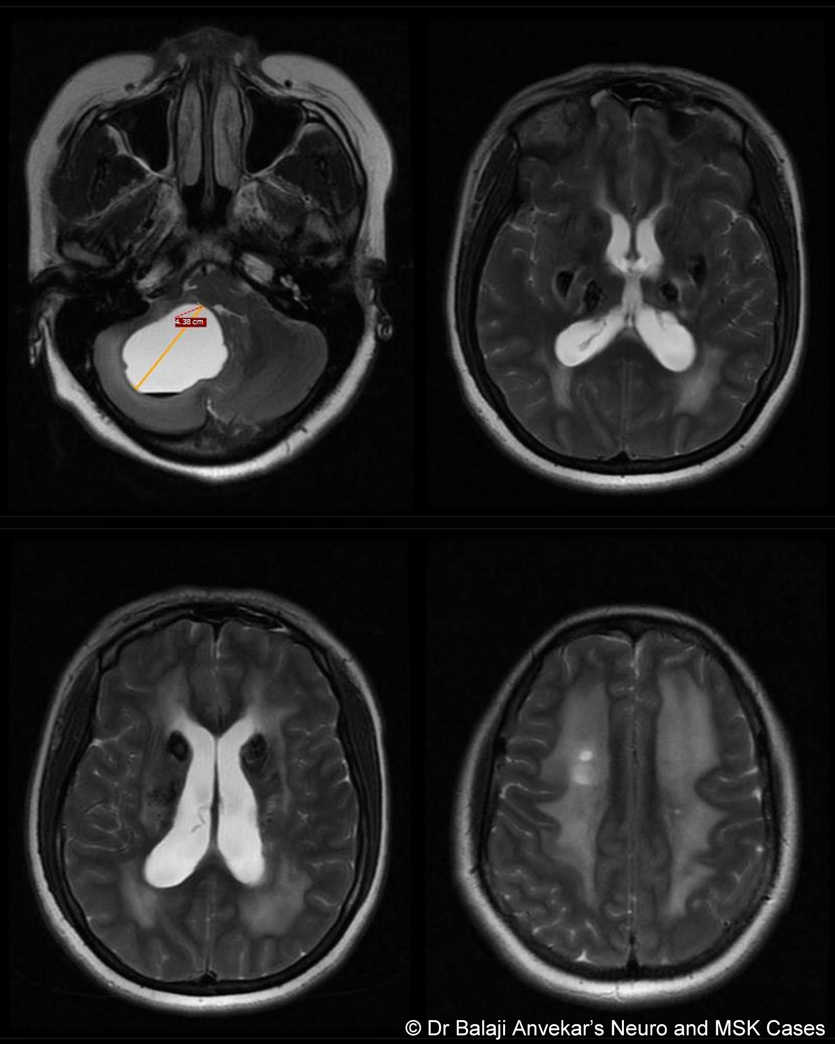 Chemical Senses by Alexandros G. Sfakianakis: Leukoencephalopathy ...