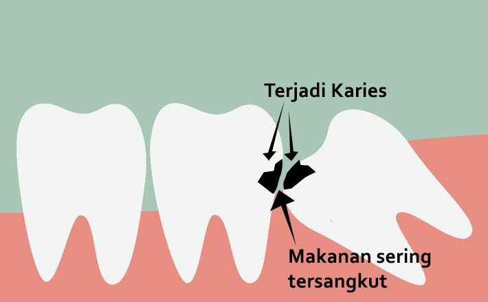 Penjelasan Lengkap Tentang Karies Gigi, Mulai dari Gejala, Faktor, Cara ...
