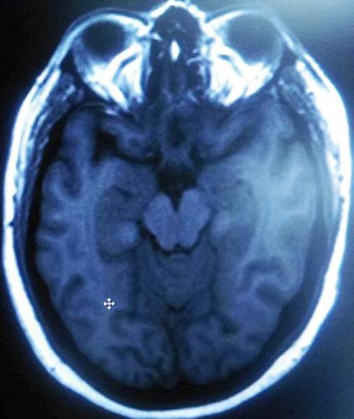 Brain death For Radiologist - Sumer's Radiology Blog