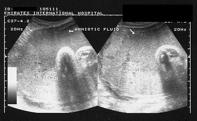 Hyperechoic Ultrasound
