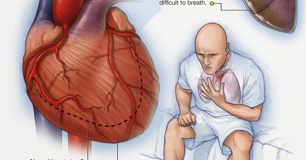 Kongestiv Hjärtsvikt ~ Medicinanteckningar