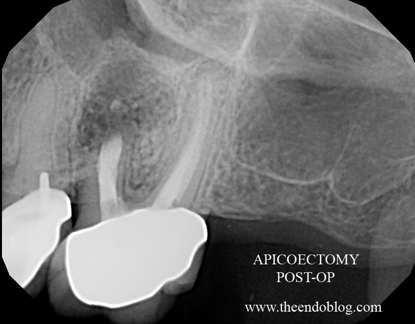 Apical Surgery for Complete Endodontic Healing | Bridgers Blog