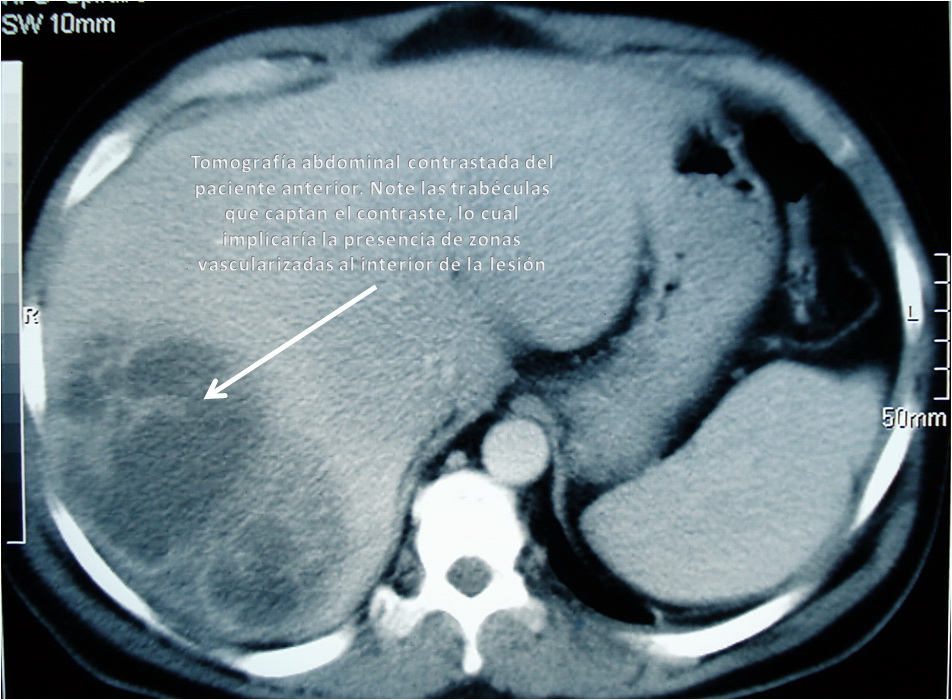Soluciones Quirúrgicas: ¿Qué es un absceso hepático?
