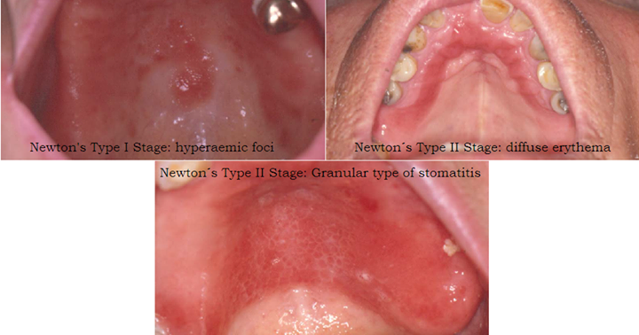 World Of Dentistry Denture Stomatitis Denture Sore Mouth