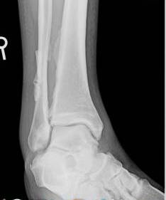 Tendoachilles Calcification-Plain Film - Sumer's Radiology Blog