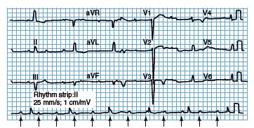 Third degree atrioventricular block / Complete heart block - ECG