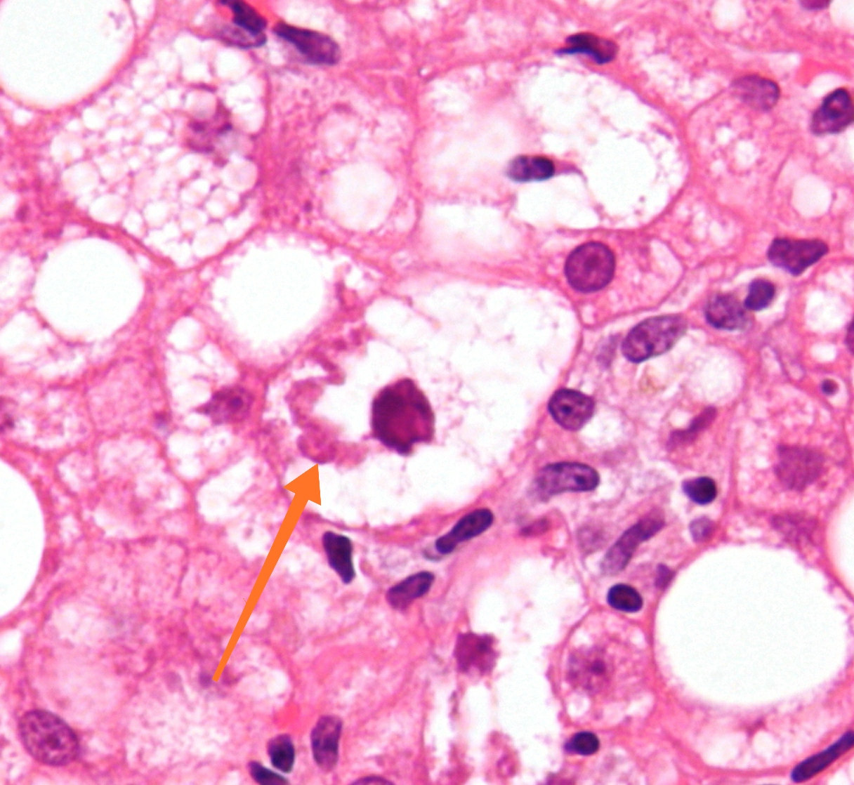 Commonly asked qiestions about Hyaline change
