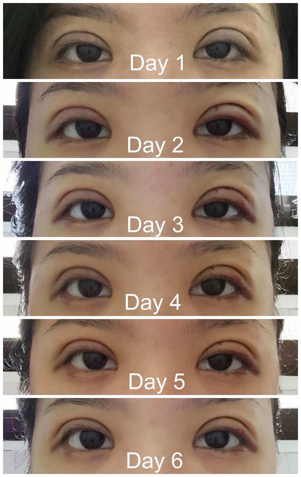 Double Eyelid Surgery: My Double Eyelid Surgery