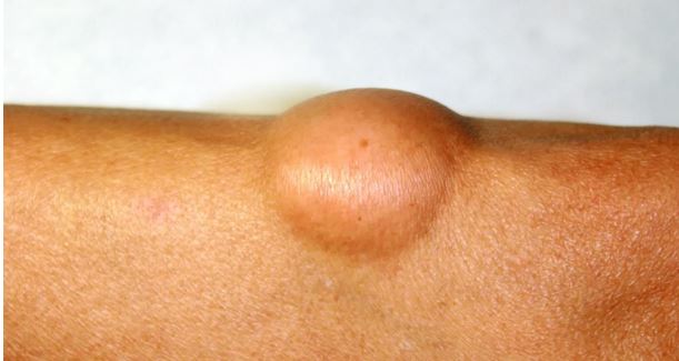 Get rid of Lipomas effectively with these natural home remedies - Learn ...