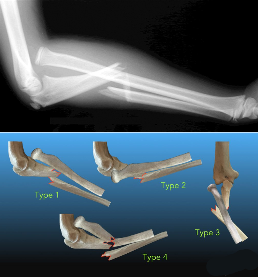 Medical Terms & Сlinical Сases : Monteggia’s fracture