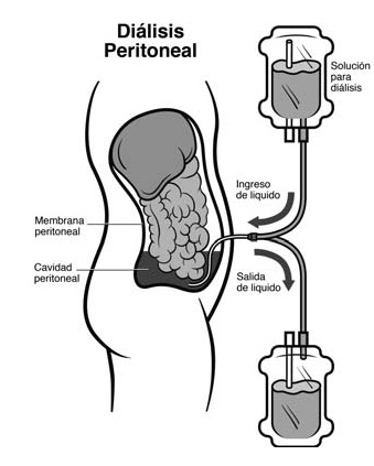 MEDICINA: LAVADO PERITONEAL