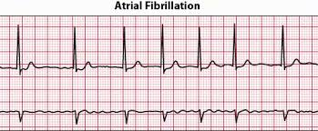 My Cancer Pilgrimage: What is AFIB?