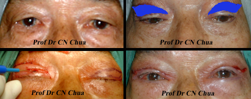 Eyelid Surgery by Prof Dr CN CHUA 蔡鐘能: Case 2: Doctor, Why Are My ...