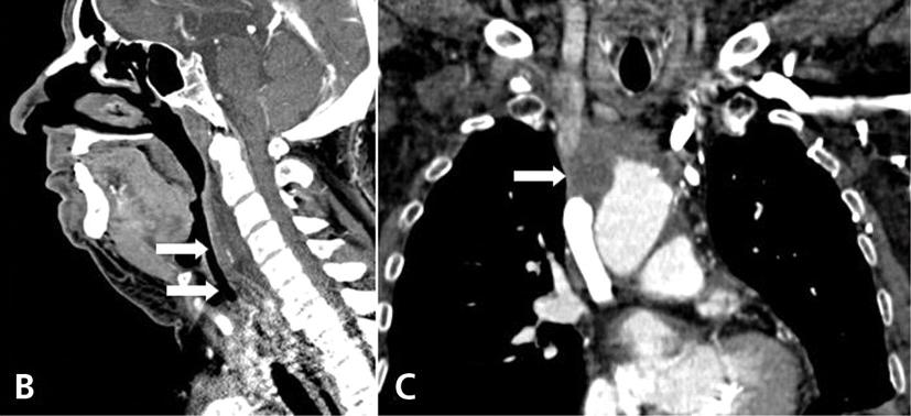 Doctors Gates: Superior vena cava syndrome