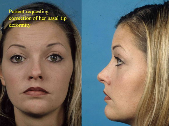 Dr. Dean Toriumi Reviews: Secondary Rhinoplasty surgeries
