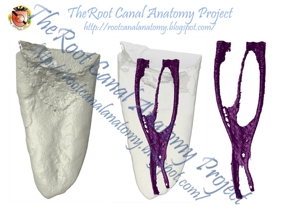The Root Canal Anatomy Project: Middle Mesial Canal - Mandibular Molar