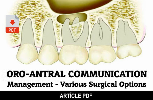 PDF: Management of Oro-antral Communication and Fistula: Various ...