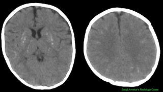 Dr Balaji Anvekar FRCR: Intracranial calcifications