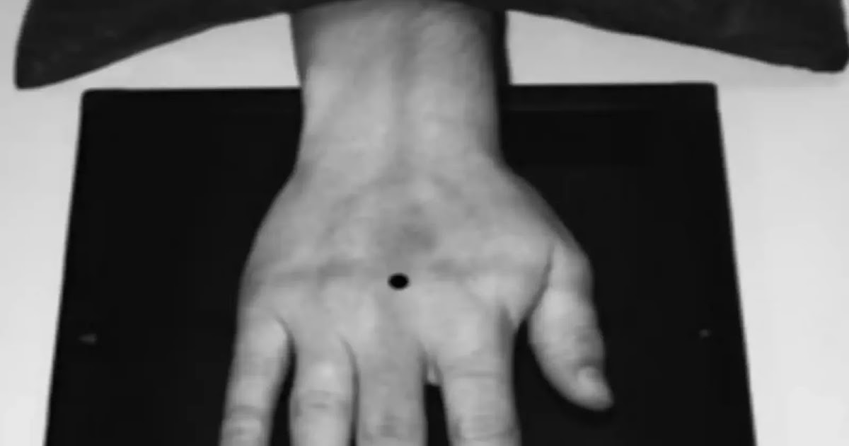 hand x-ray (broken hand xray) - paramedical guru